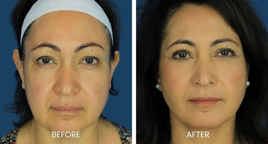 Female Face Lift - Plano Plastic Surgery