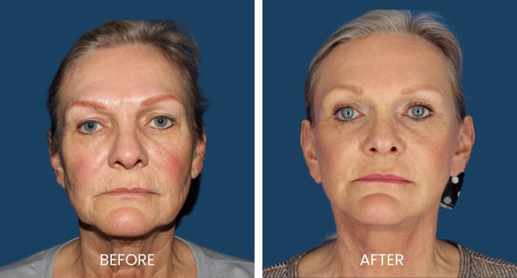 Female Face Lift - Plano Plastic Surgery