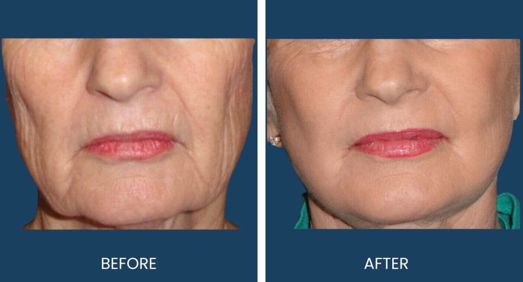 Female Face Lift - Plano Plastic Surgery