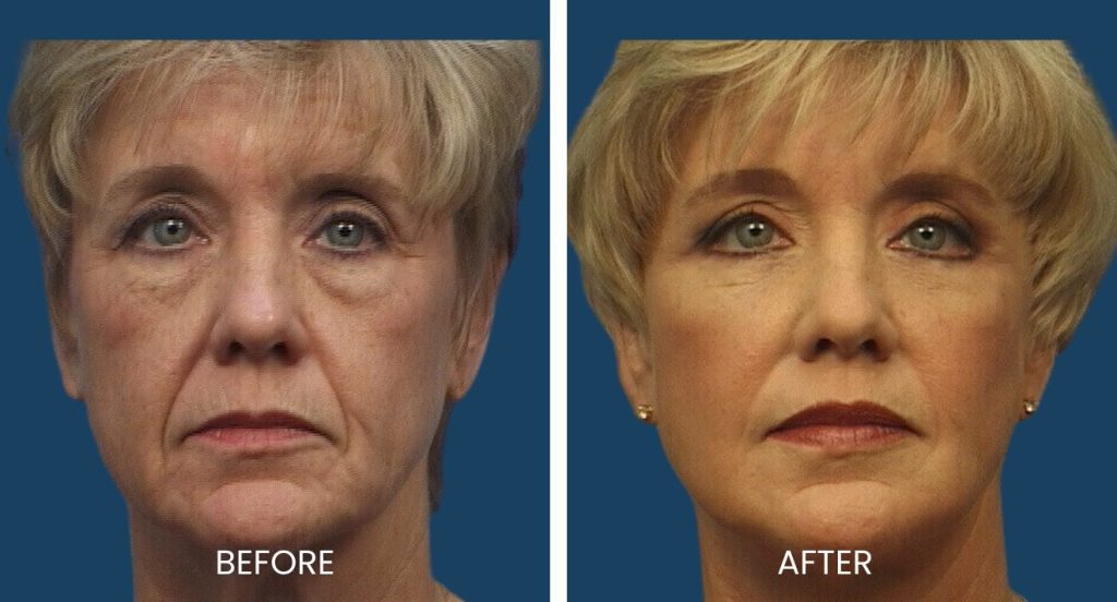 Female Face Lift - Plano Plastic Surgery