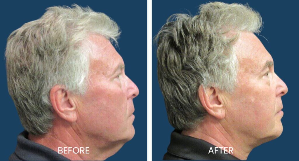 Male Neck Lift Before and After - Plano Plastic Surgery